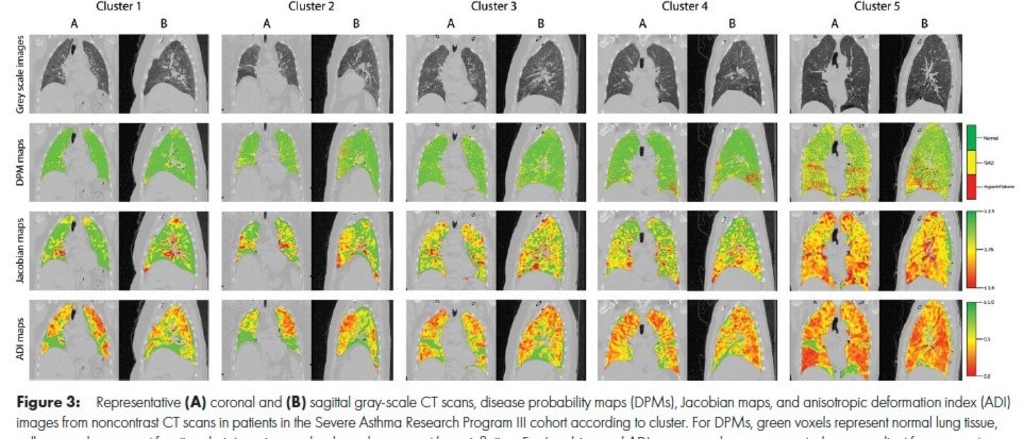 Paper on CT biomarkers to assess and phenotype asthma published | The ...